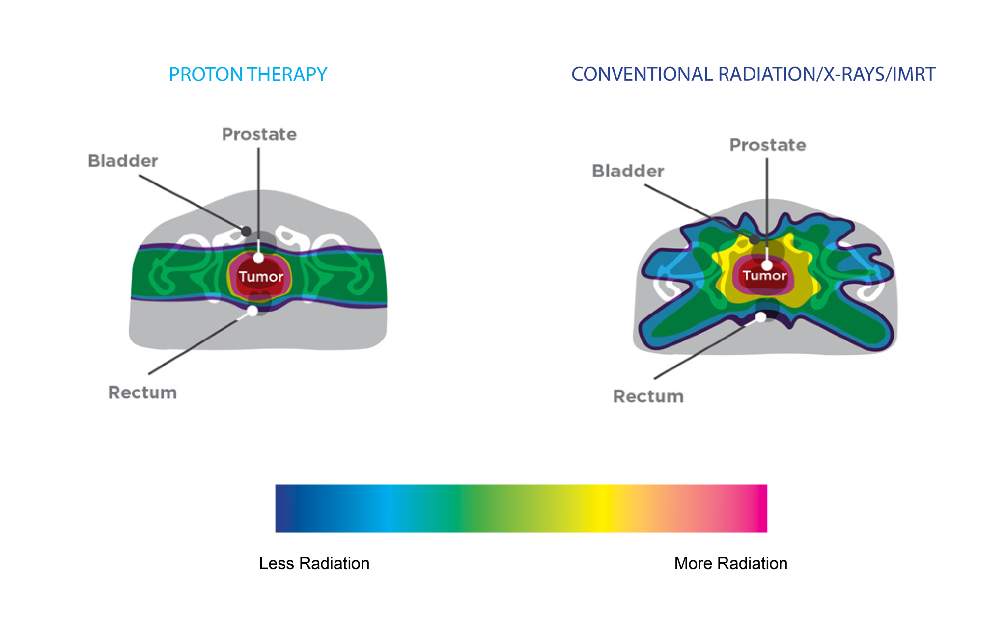 Proton Beam Therapy - Tennessee Oncology Proton Center